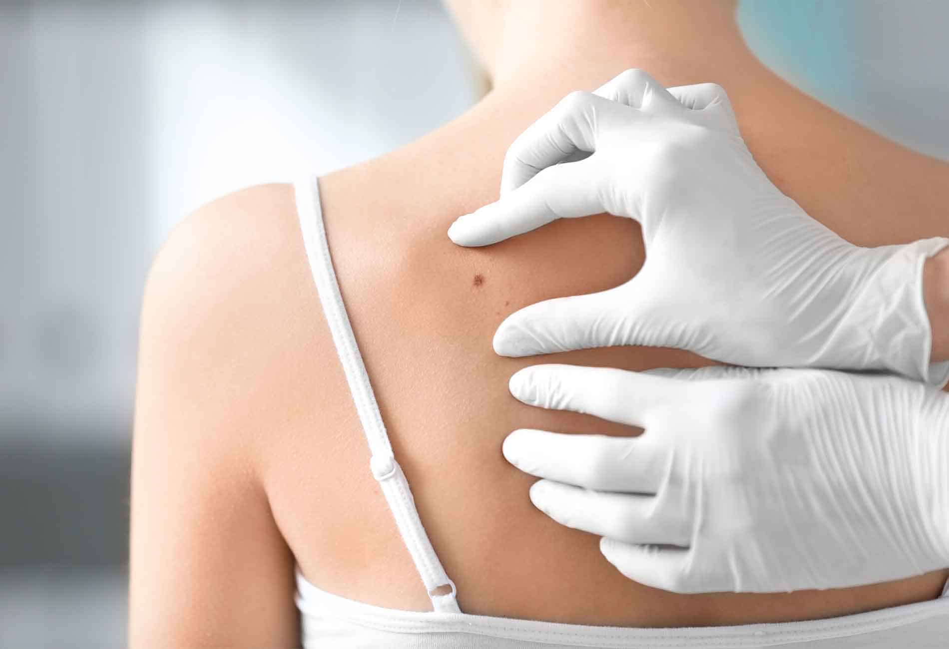 Skin Cancer Causes Symptoms Treatment And Prevention